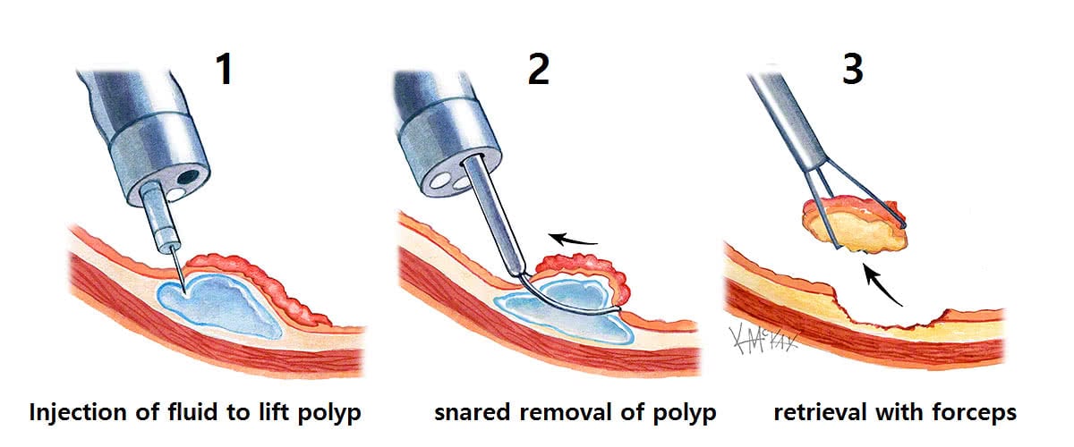 Endoscopic Mucosal Resection (EMR) – Specialist Surgeons Sydney