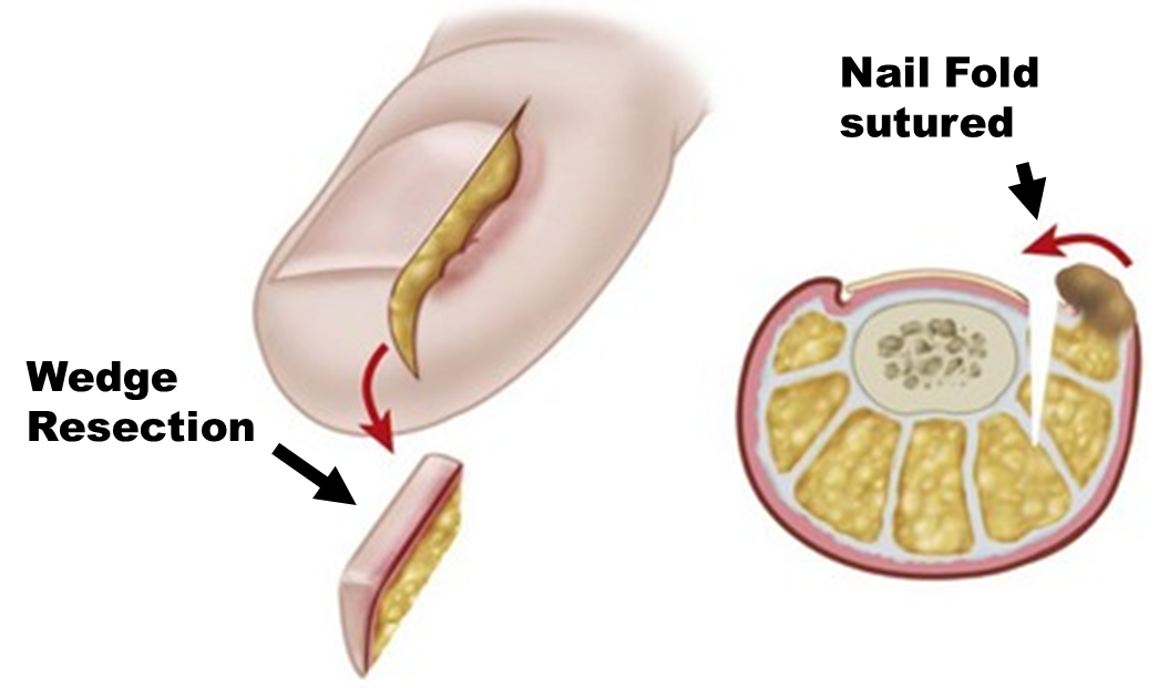 Ingrown Toenail Surgery – Specialist Surgeons Sydney